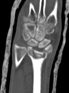Ce Este Fractura Epifizei Distale de Radius? | Dr. Daniel Vîlcioiu