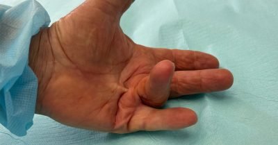 Boala Dupuytren: ce este și cum se tratează