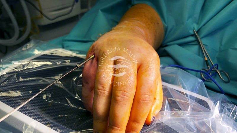 Fracturi de falange și metacarpiene | Dr. Vilcioiu Daniel